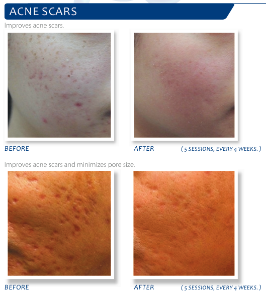 EpicDermis Medical :: Professional Dermapen Treatments in South London